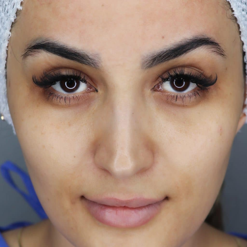 Microblading vs. Eyebrow Transplant: Top 10 Differences